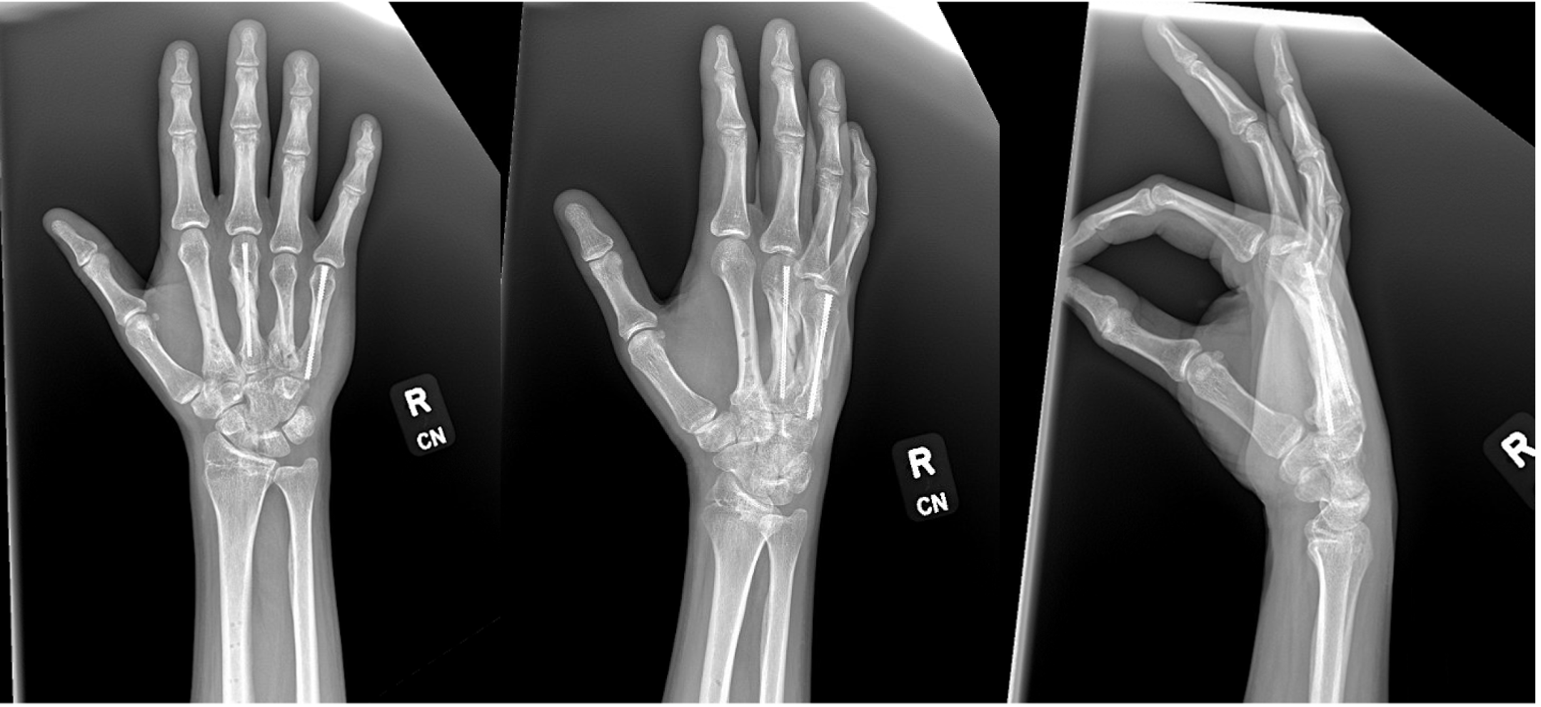 The use of NX Nail for fixation of multiple metacarpal fractures following a motorcycle accident